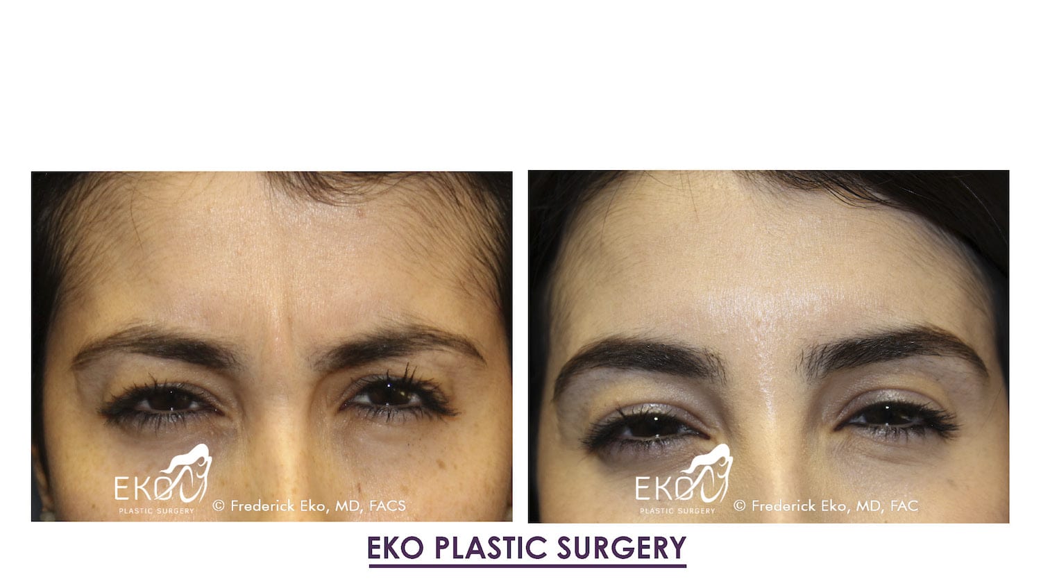 BOTOX Injections in Palm Desert, CA | Eko Plastic Surgery